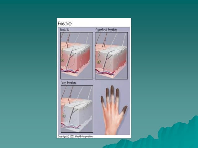 COLD INJURIES: DESCRIPTION, TREATMENT AND PREVENTION | PPT
