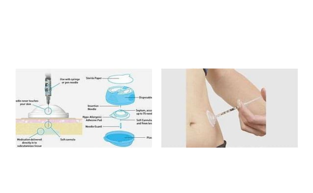 Modern Insulin Delivery Methods And Injection Sites – MRQOI