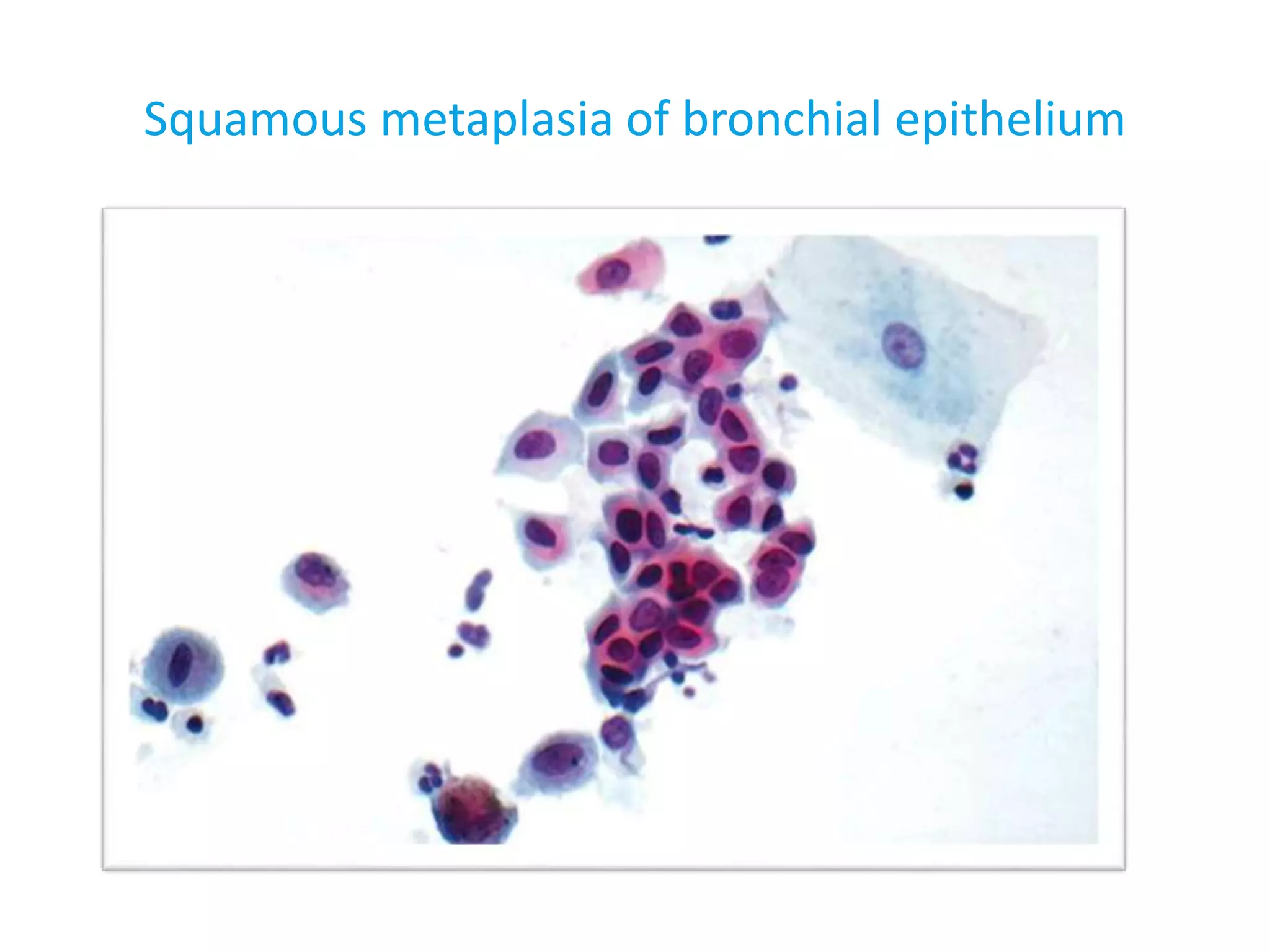 Cytology of BAL and Brushings | PPSX