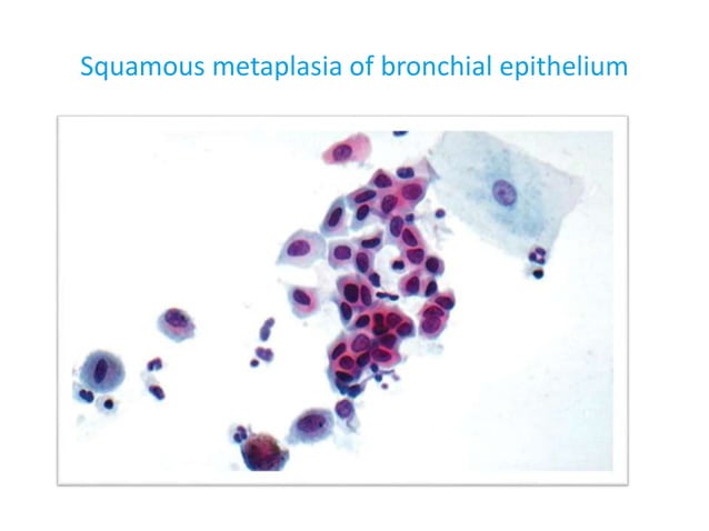 Cytology of BAL and Brushings | PPSX | Lung and Respiratory Health ...