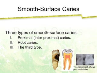 Dental Caries | PDF | Oral care | Personal Care