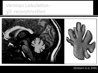 CT - Dandy Walker Syndrome | PPT