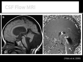 CT - Dandy Walker Syndrome | PPT