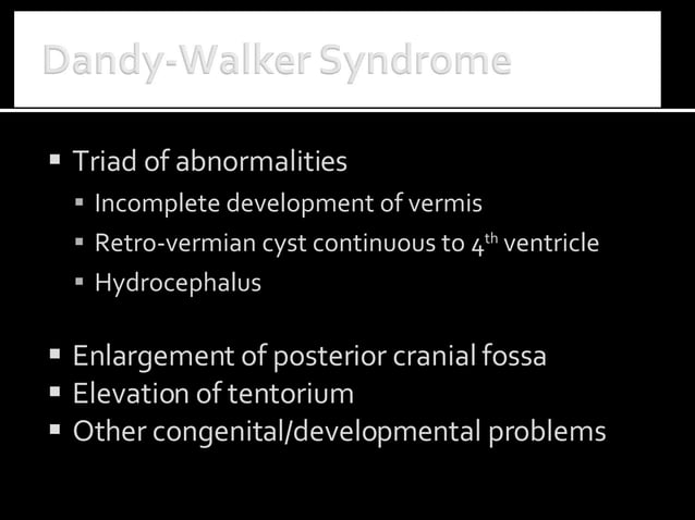 CT - Dandy Walker Syndrome | PPT