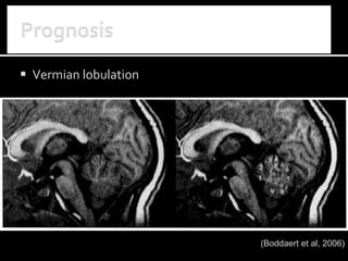 CT - Dandy Walker Syndrome | PPT