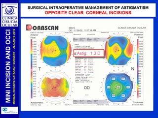 SURGICAL INTRAOPERATIVE MANAGEMENT OF ASTIGMATISM | PPT