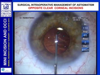 SURGICAL INTRAOPERATIVE MANAGEMENT OF ASTIGMATISM | PPT