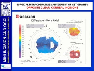 SURGICAL INTRAOPERATIVE MANAGEMENT OF ASTIGMATISM | PPT