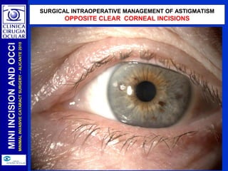 SURGICAL INTRAOPERATIVE MANAGEMENT OF ASTIGMATISM | PPT