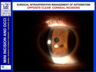 SURGICAL INTRAOPERATIVE MANAGEMENT OF ASTIGMATISM | PPT
