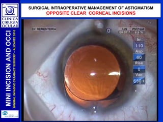 SURGICAL INTRAOPERATIVE MANAGEMENT OF ASTIGMATISM | PPT