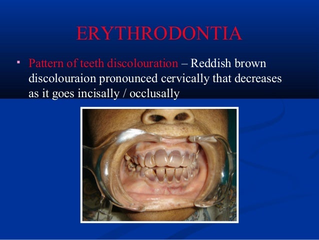 ERYTHROPOIETIC PORPHYRIA WITH ADENOMATOID ODONTOGENIC TUMOUR AS AN IN…