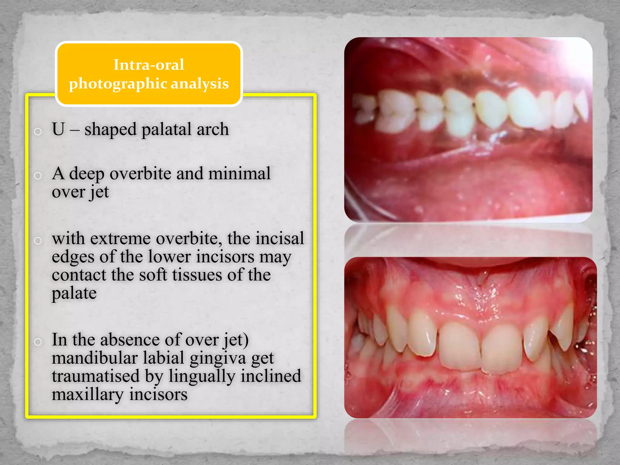class 2 malocclusion | PPTX