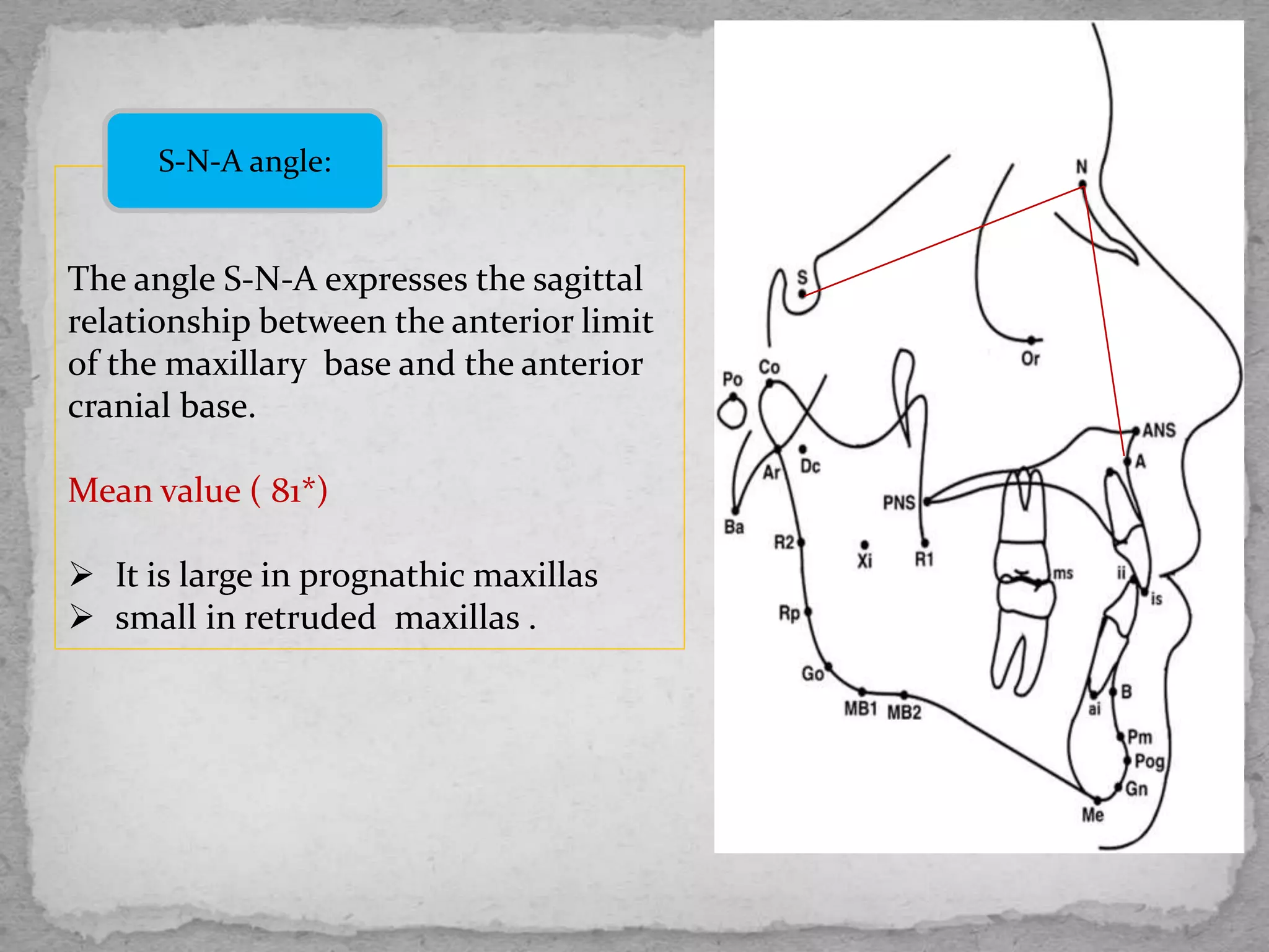 class 2 malocclusion | PPTX