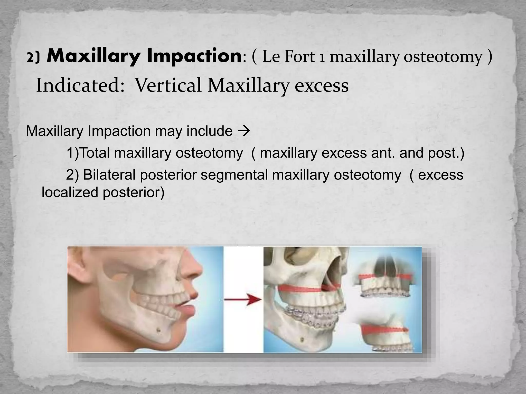 class 2 malocclusion | PPTX