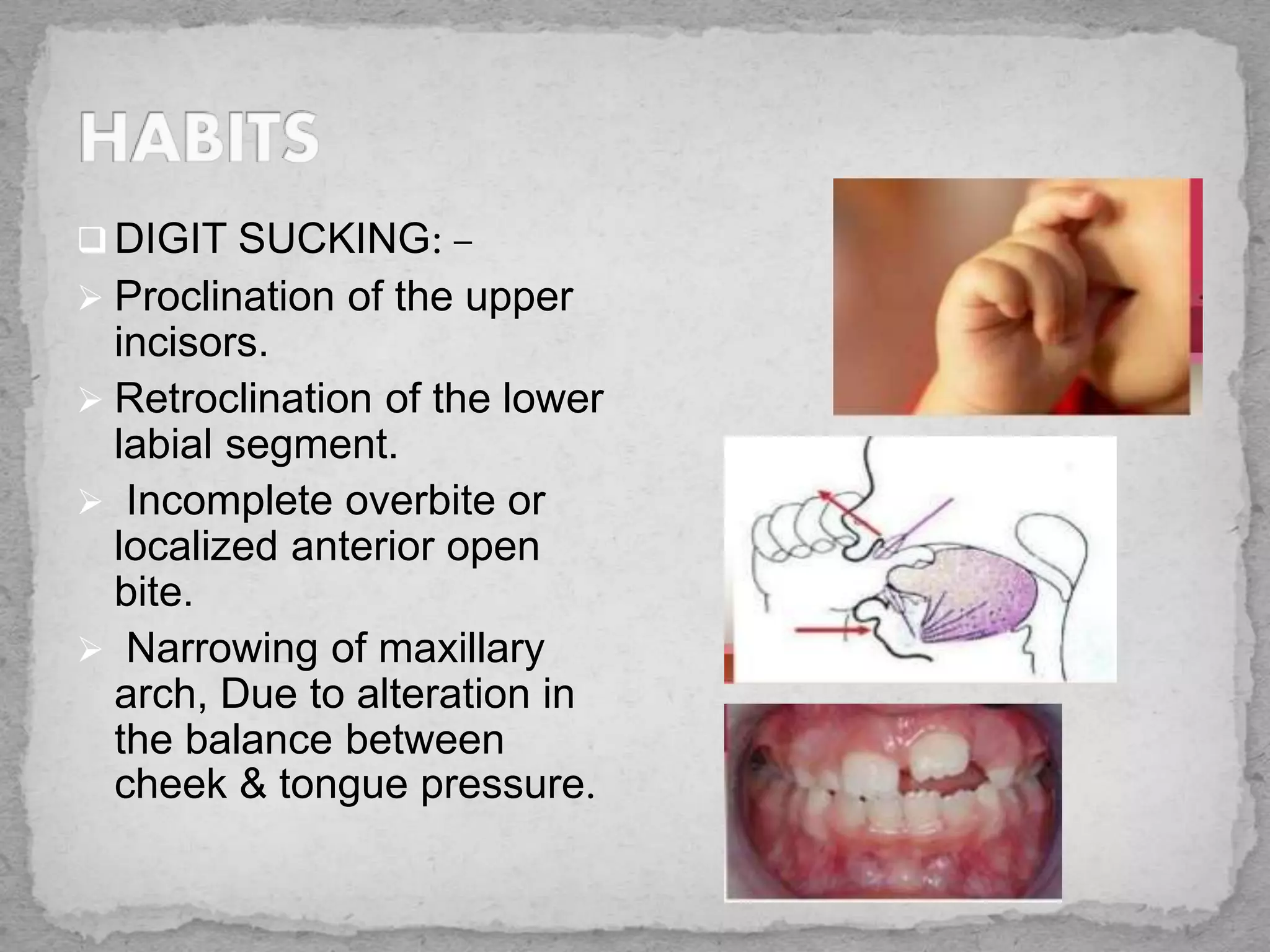 class 2 malocclusion | PPTX