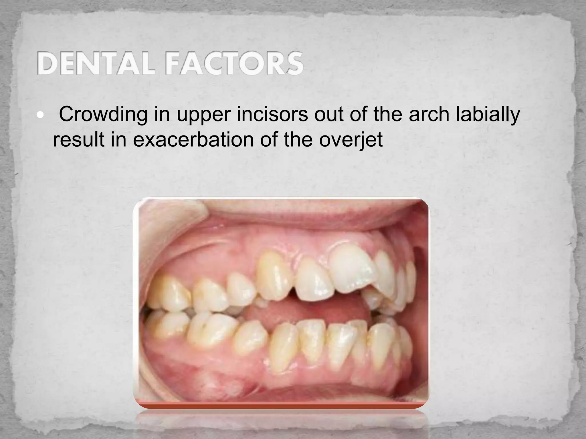 class 2 malocclusion | PPTX