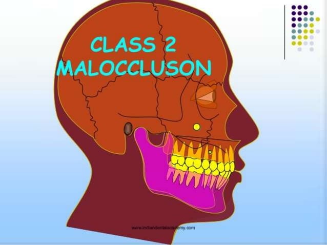 class 2 malocclusion | PPTX