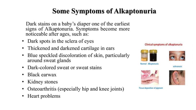 Maple Syrup Urine Disease, Phenylketonuria & Alkaptonuria | PPTX