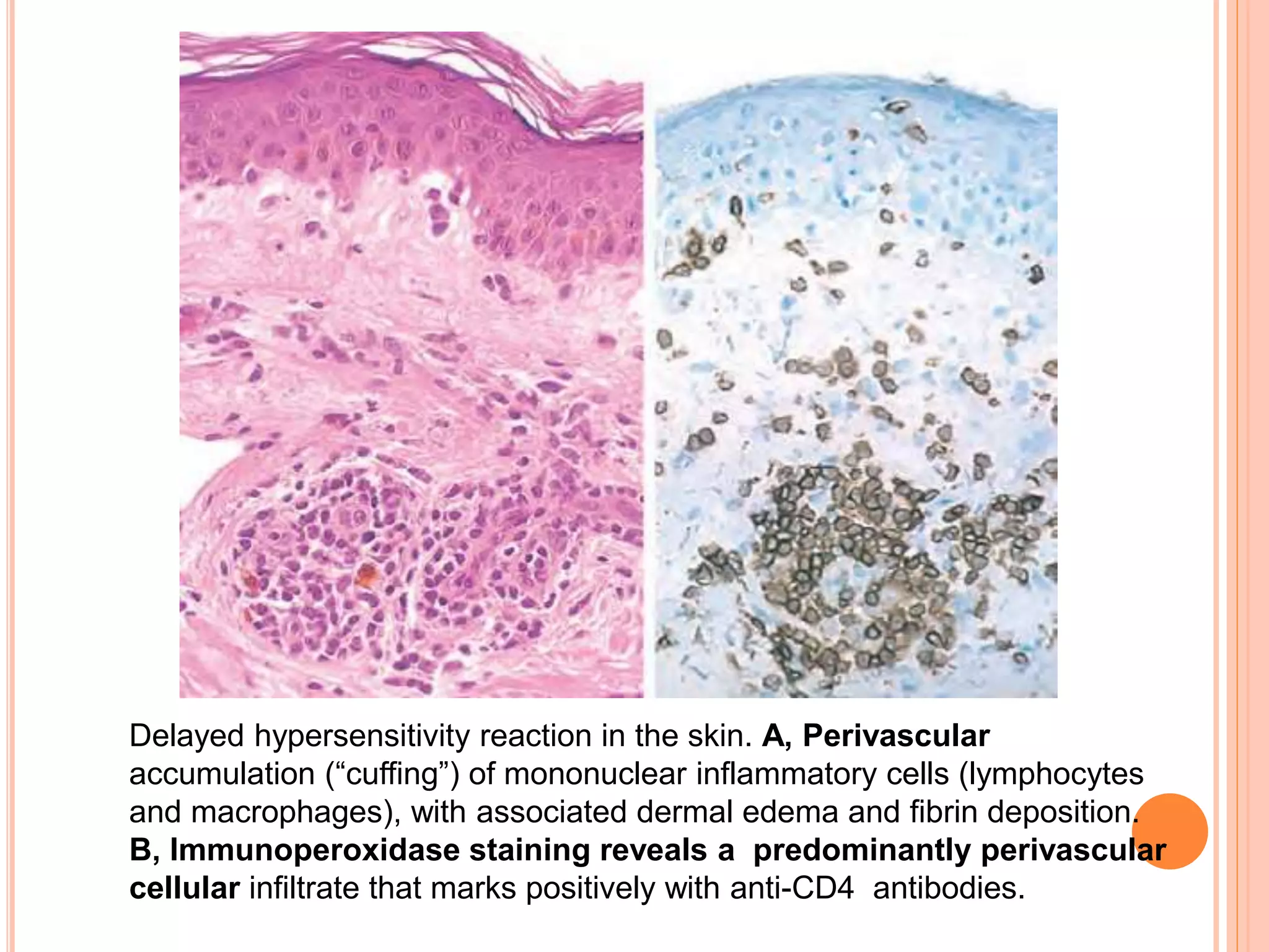 Final type-iv hypersensityvity | PPTX