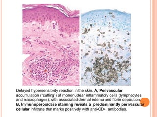 Final type-iv hypersensityvity | PPTX