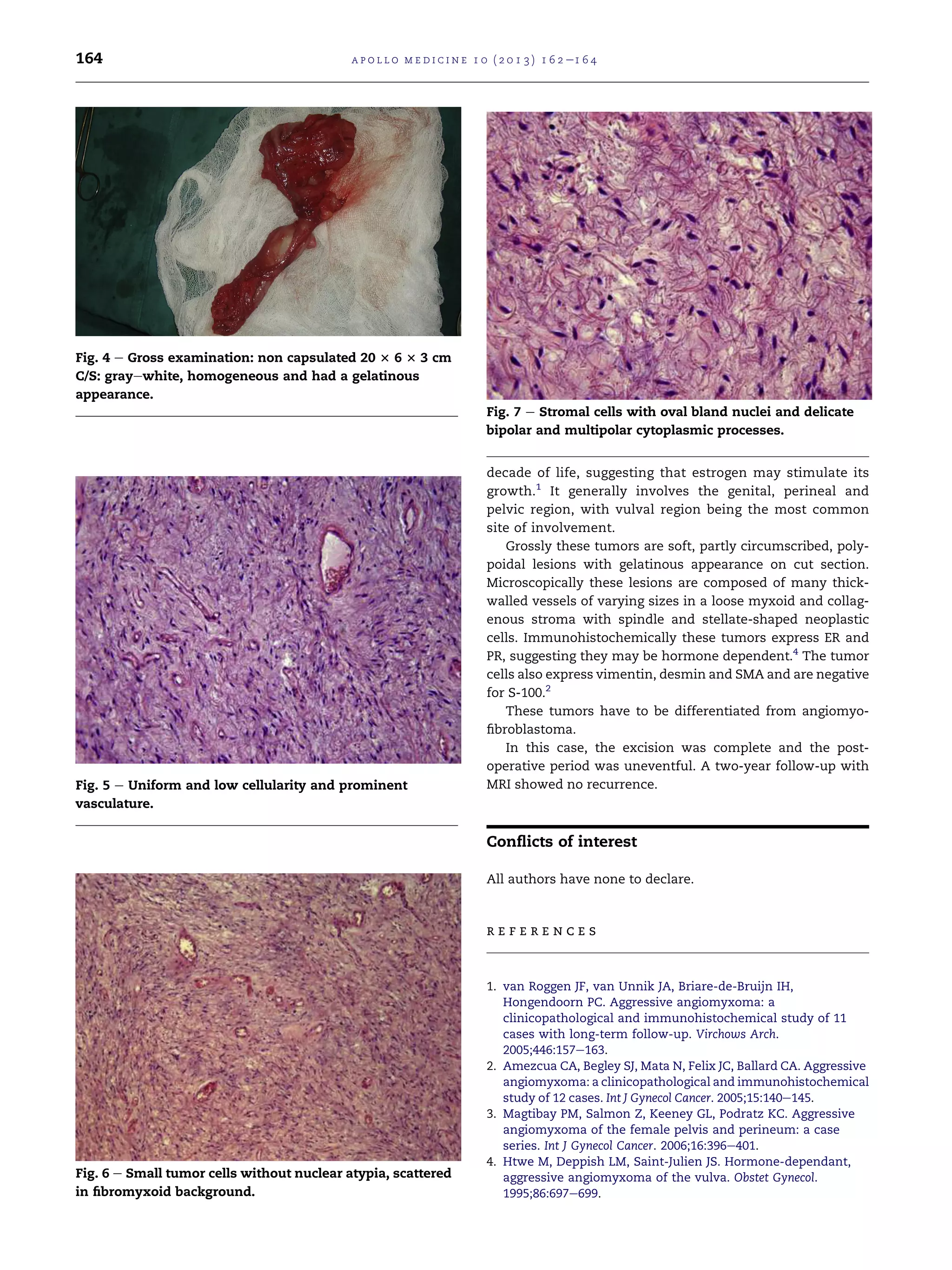 Angiomyxoma - A Rare Case Report | PDF