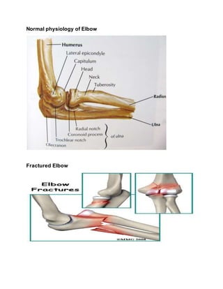 fractured elbow | DOCX