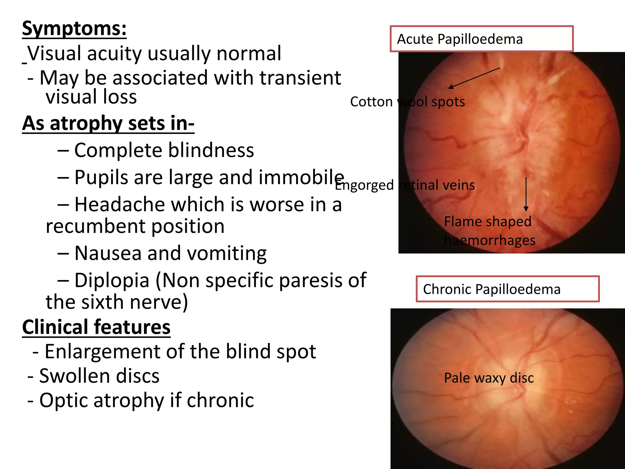 Common Neuro Ophthalmological Disorder | PPTX