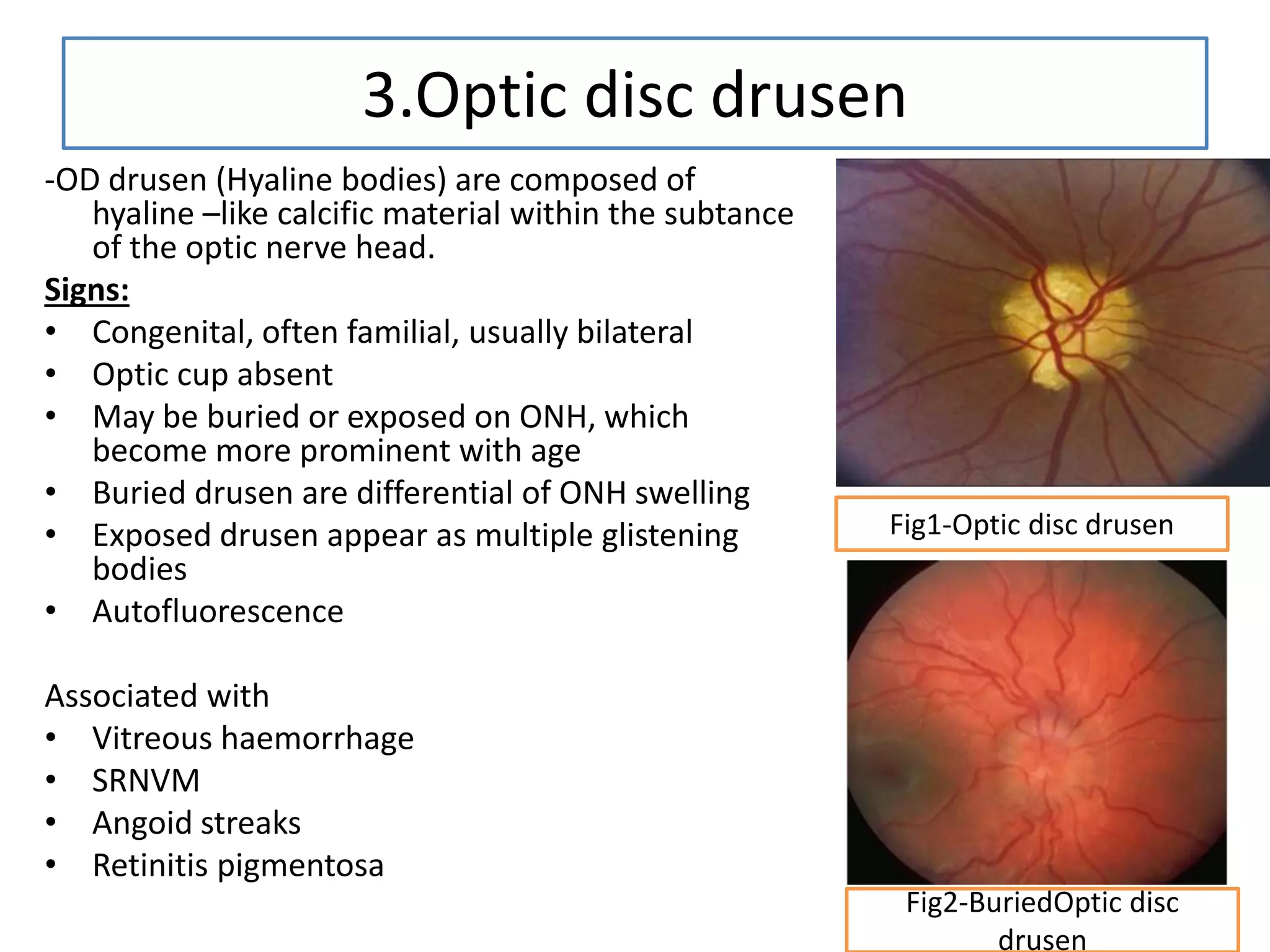 Common Neuro Ophthalmological Disorder | PPTX