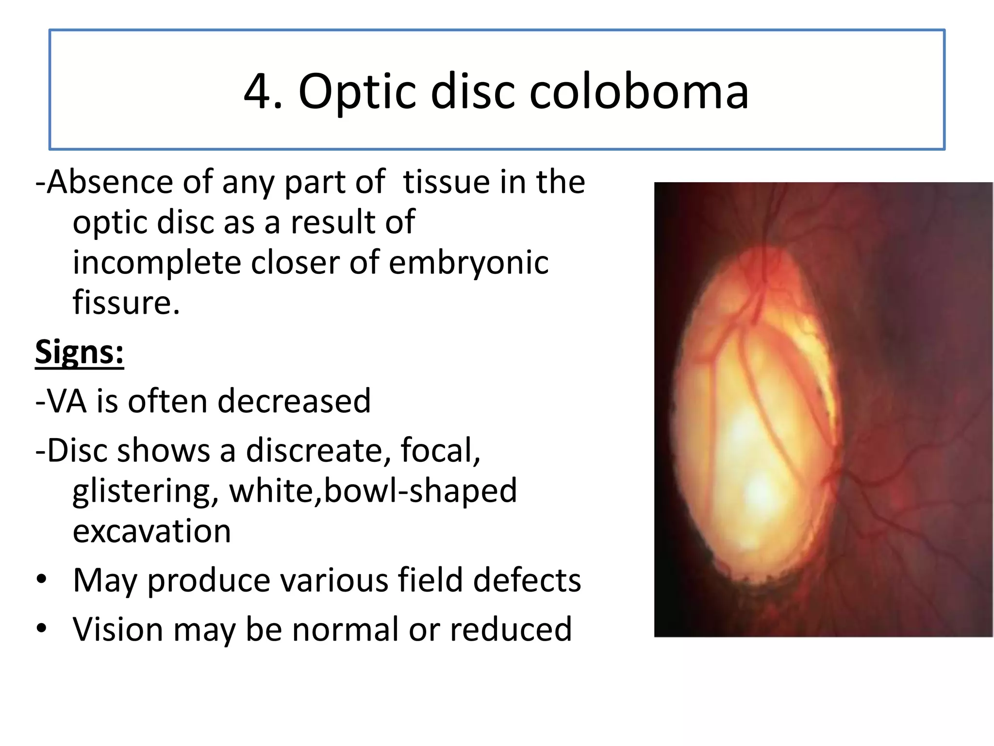 Common Neuro Ophthalmological Disorder | PPTX