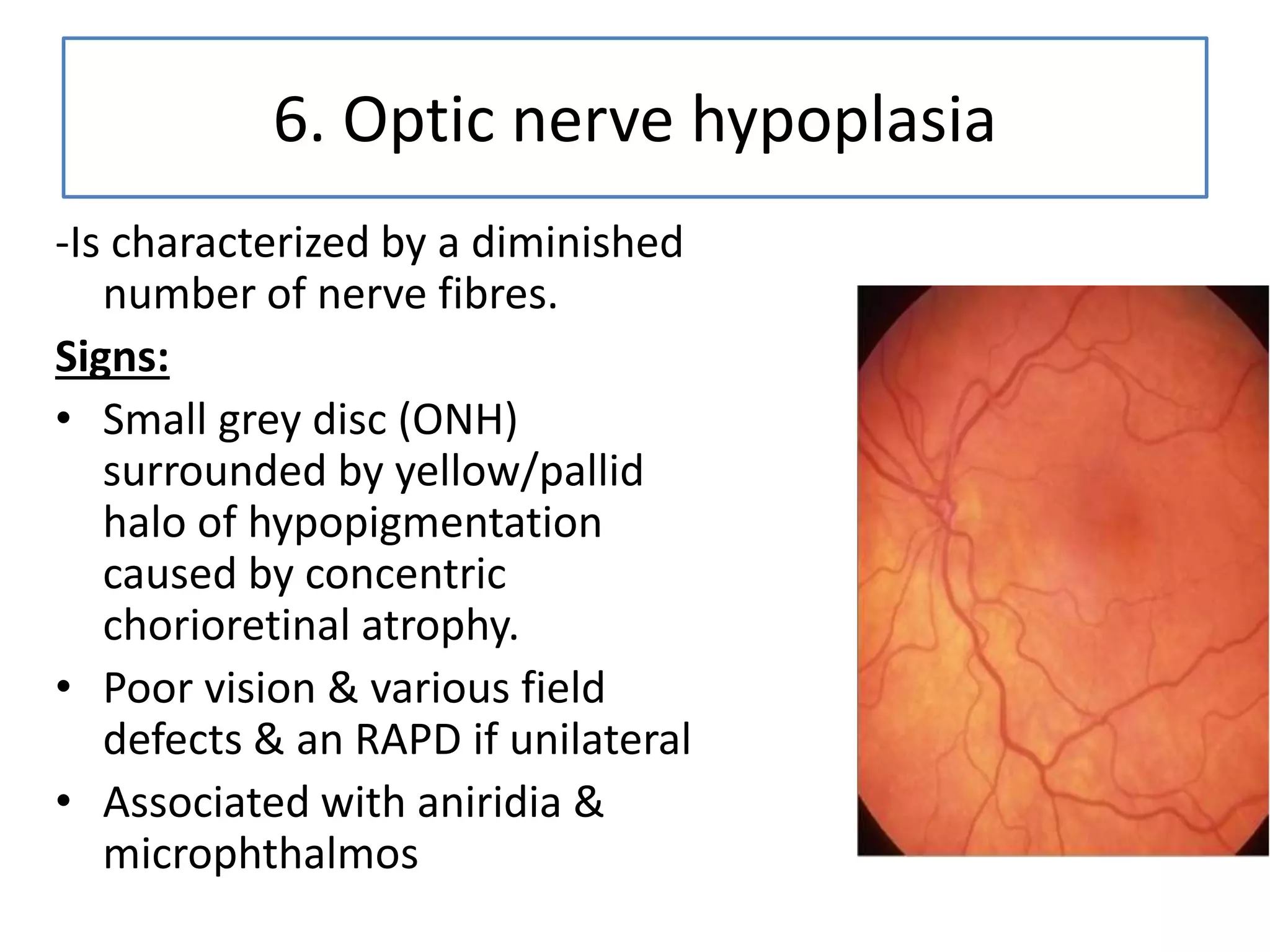 Common Neuro Ophthalmological Disorder | PPTX
