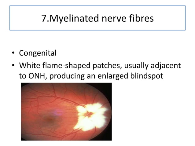 Common Neuro Ophthalmological Disorder | PPTX | Brain and Nervous ...