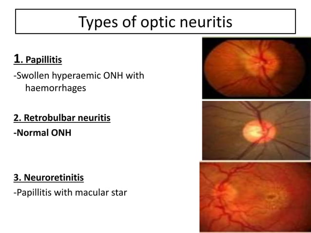 Common Neuro Ophthalmological Disorder | PPTX | Brain and Nervous ...