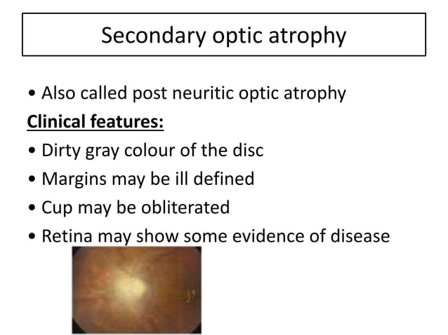 Common Neuro Ophthalmological Disorder | PPTX | Brain and Nervous ...