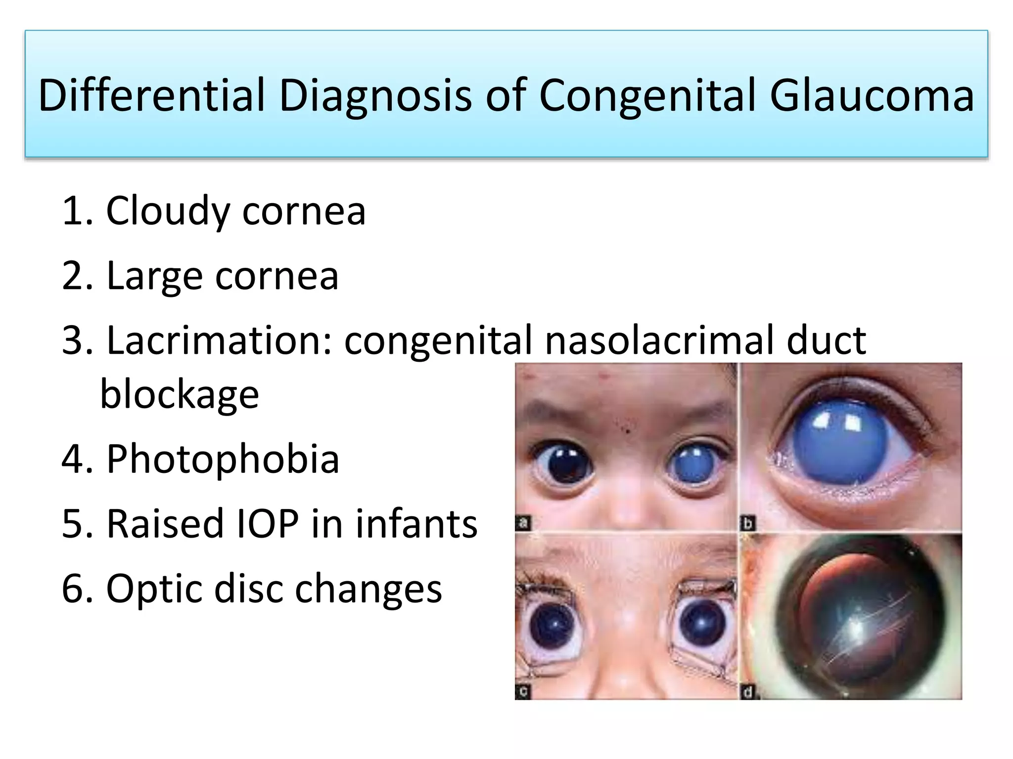 Congenital Glaucoma-Optometric managment.ppt