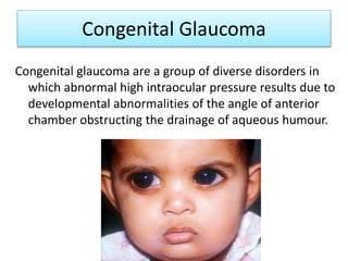 Congenital Glaucoma-Optometric managment.ppt