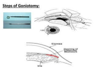 Congenital Glaucoma-Optometric managment.ppt
