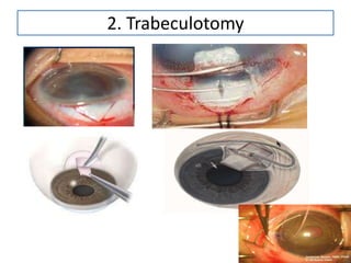 Congenital Glaucoma-Optometric managment.ppt