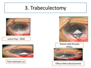 Congenital Glaucoma-Optometric managment.ppt