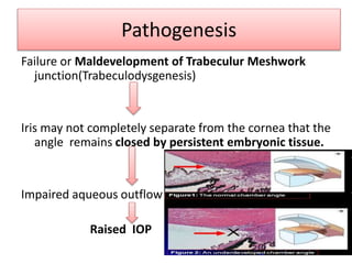 Congenital Glaucoma-Optometric managment.ppt