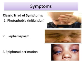 Congenital Glaucoma-Optometric managment.ppt
