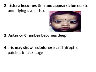 Congenital Glaucoma-Optometric managment.ppt