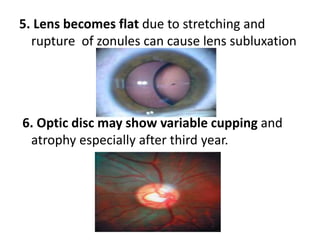 Congenital Glaucoma-Optometric managment.ppt
