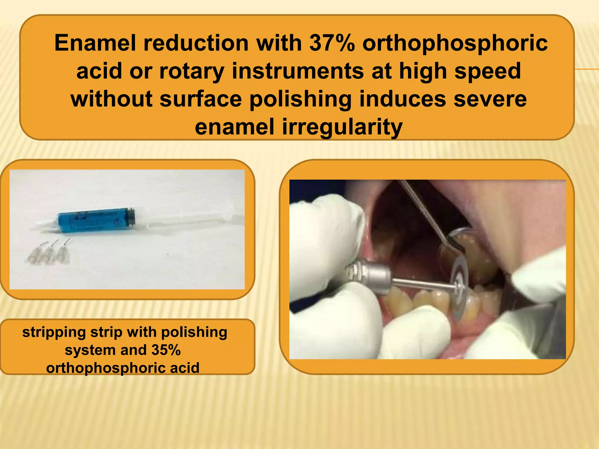 interproximal reduction of enamel as part of orthodontics | PPTX