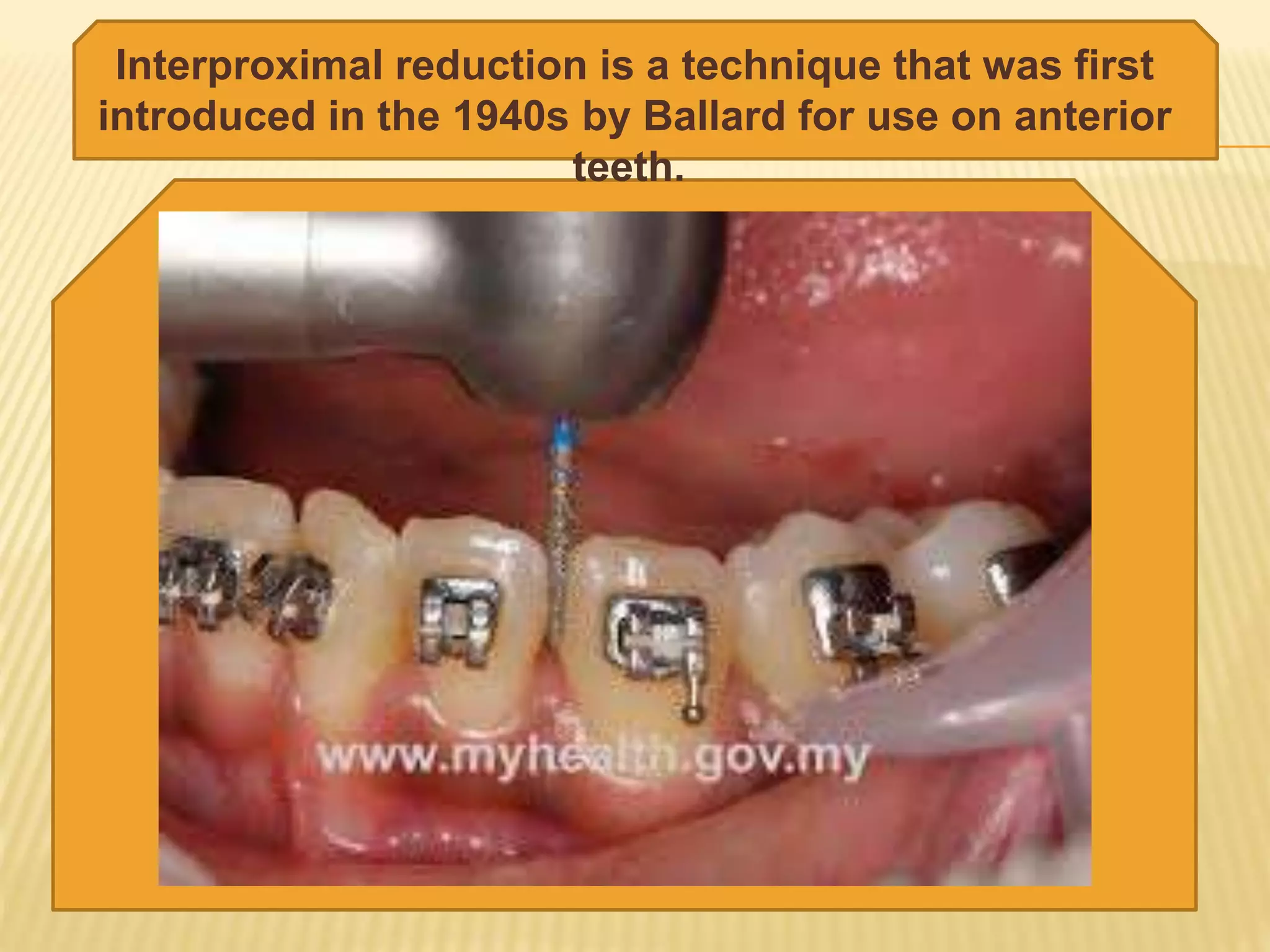 interproximal reduction of enamel as part of orthodontics | PPTX