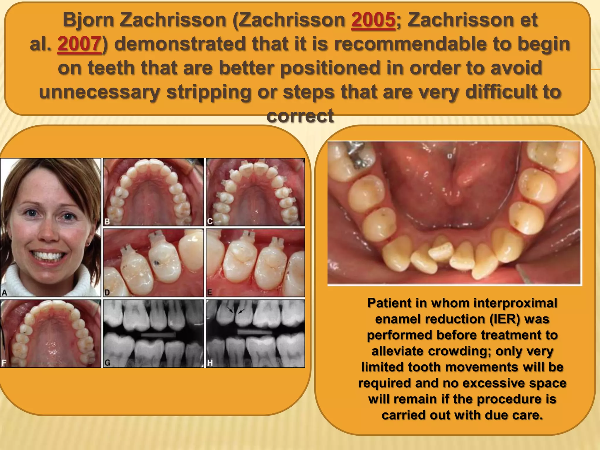 interproximal reduction of enamel as part of orthodontics | PPTX