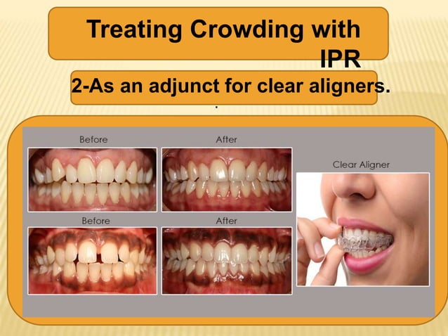 interproximal reduction of enamel as part of orthodontics | PPTX