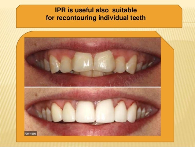 interproximal reduction of enamel as part of orthodontics