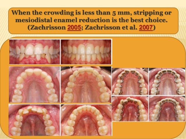 interproximal reduction of enamel as part of orthodontics