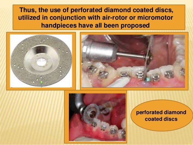 interproximal reduction of enamel as part of orthodontics